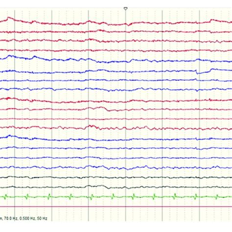 Initial Electroencephalogram Eeg Shows Mild Encephalopathy Download Scientific Diagram