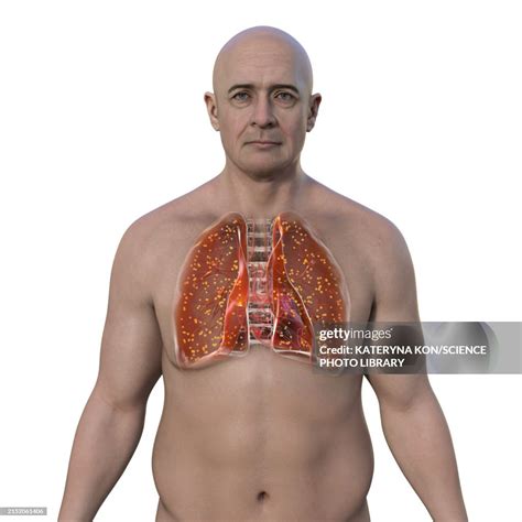 Miliary Lung Tuberculosis Illustration High Res Vector Graphic Getty