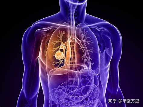 小心！过量补充维生素c和e，会促进肺癌生长和转移！ 知乎