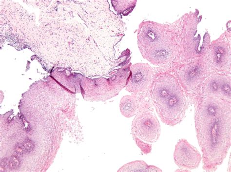곤지름사진 증상 전염 치료 알아봐요 남성 여성 네이버 블로그