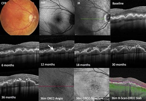 Interpretation Of Subretinal Fluid Using Oct In Intermediate Age