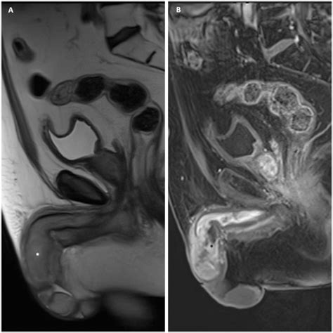 Total Penectomy As Treatment Option For Solitary Penile Metastasis In