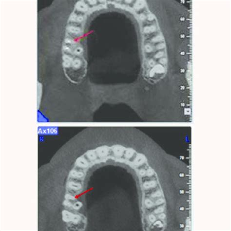 Pdf Use Of Cbct In The Detection Of Second Mesiobuccal Mb2 Canal In Maxillary First Molar