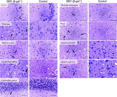 Widespread Marked Enlargement Of Neurons With Cytoplasmic Vacuolation