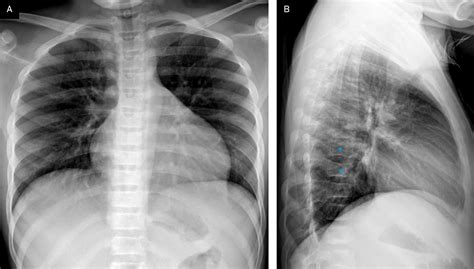 Sickle Cell Disease Applied Radiology