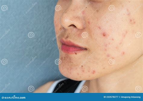 Close Up Of Woman Half Face With Problems Of Acne Inflammation Papule