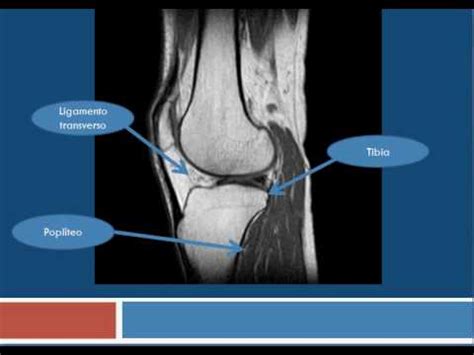 Resonancia Magnetica De Rodilla T1 Youtube