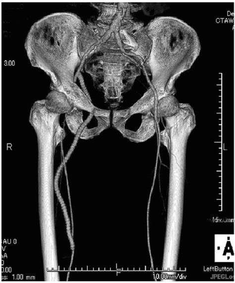 Figure 2 From Obturator Foramen Bypass For Infective Groin Caused By Figure 2 From Obturator Foramen Bypass For Infective Groin Caused By