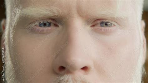 Close Up Of Handsome Albino Male Eyes Concept Of Diversity Equality