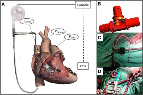 Muhammad Zohaib Akram On Linkedin Pulsatile Right Ventricular Assist