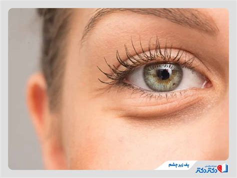 پف زیر چشم چیست؟ 12 علت پف چشم روش‌های فوری درمان خانگی