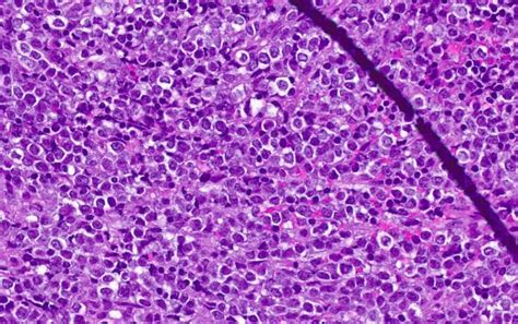 Pathology Outlines Myeloid Sarcoma