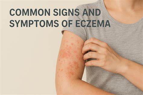 Common Signs And Symptons Of Eczema Beacon Skin And Surgeries