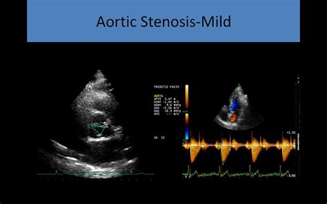 Abnormal Echocardiogram