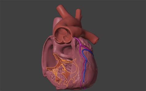 3d Model Of Heart With Truncus Arteriosus Congenital Heart Defects