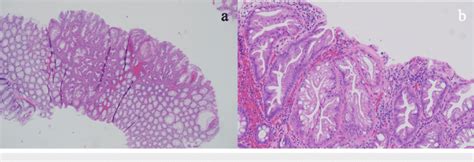 Histologic Appearance Of The Serrated Lesion In The Sigmoid