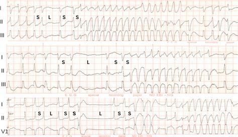 The Short‐long‐short‐short Sequence And Polymorphic Ventricular Tachycardias Storm Liu 2023