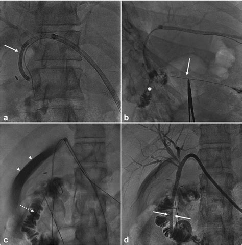 Stepwise Percutaneous Approach To Treat Severe Benign Hepaticojejunostomy Stenosis Pmc