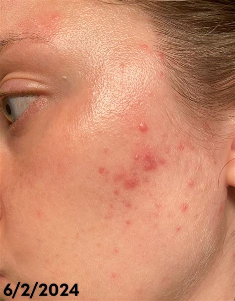How Long Did Your Post Pill Hormonal Acne Last Racne