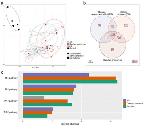 Genomic Profiling Of The Overlap Phenotype Between Psoriasis And Atopic Dermatitis Pmc