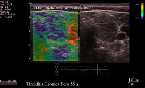 Tiroiditis Crónica
