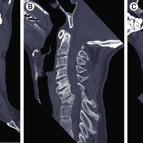 Pre Operative Computed Tomography Coronal View A Revealed C7 Burst