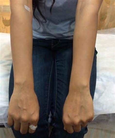 IV Infusion Therapy Tender Skin International