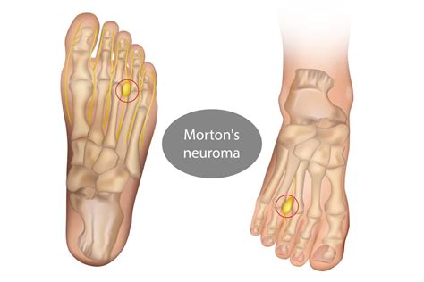 Morton Neuroma Mortons Metatarsalgia Intermetatarsal Neuroma And Intermetatarsal Space