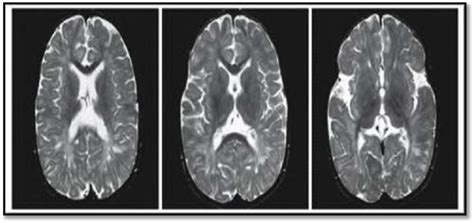 Mucopolysaccharides A 3 Years Old Male With Hurler Syndrome Mps I T2