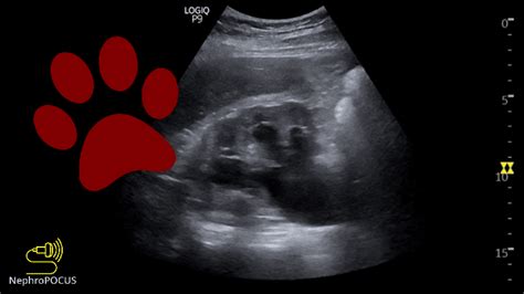 A Case Of Hydronephrosis Nephropocus