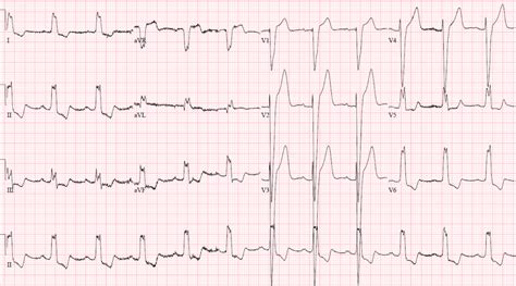 Hyperacute T Waves And Occlusion Mi Ecg Cases Emergency Medicine Cases
