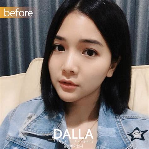 รีวิวคุณใบเฟริน Dalla Modle Dalla Plastic Surgery