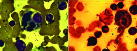 Bone Marrow Aspiration Cytopathology Of Bone Marrow Aspirate Shows