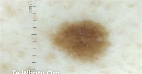 Melanocytic Naevus Image