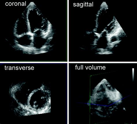 Three Dimensional Echocardiography Approaches And Clinical Utility Heart