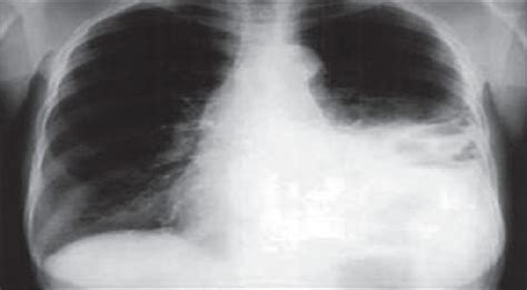 Thoracoscopic Management Of Empyema Thoracis Journal Of Minimal Access Surgery