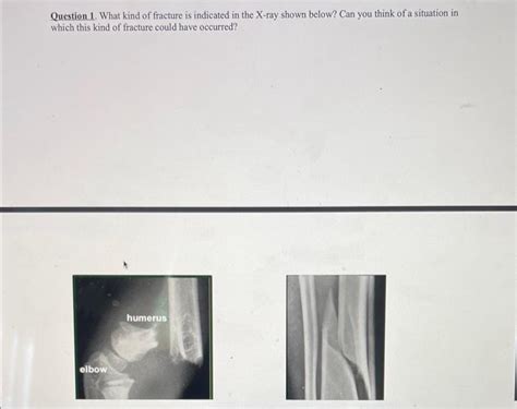 Solved Question 1 What Kind Of Fracture Is Indicated In The