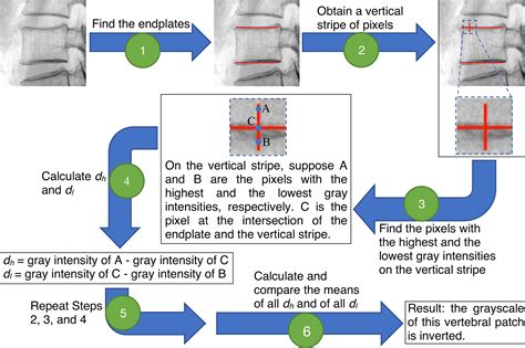 Deep Learning Classification Of Spinal Osteoporotic Compression