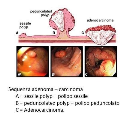 Polipo Di 3 Mm Nel Colon Sigmoideo