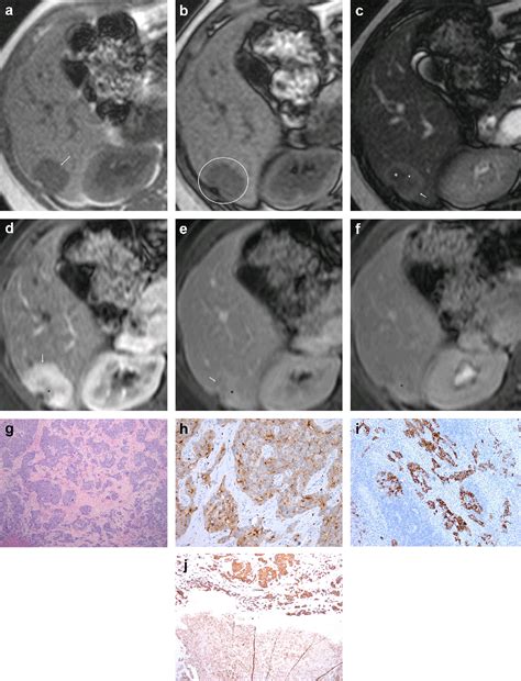 Figure From Current Update On Combined Hepatocellular Cholangiocarcinoma Semantic Scholar