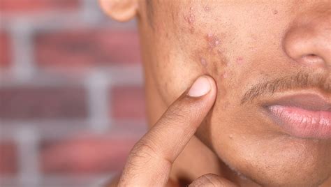 Acne Scars Vs Hyperpigmentation What Works For Each