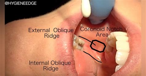 Inferior Alveolar Nerve Block Step By Step • Video • 47 Off
