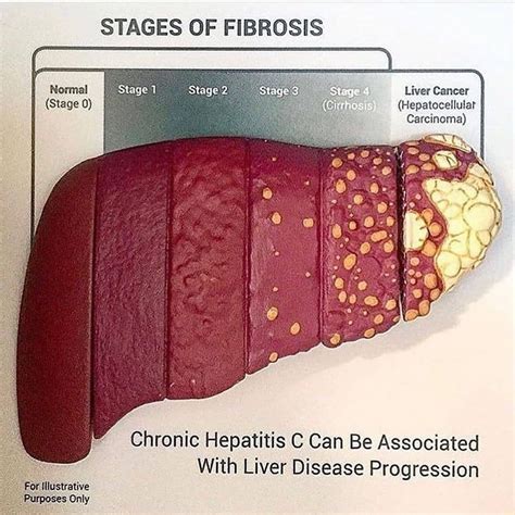 Difference Between Ulcerative Colitis And Crohn S Disease Artofit