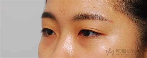 [beforeandafter]目の手術 自然癒着 埋没法＋目つき矯正 Am整形外科 公式ブログ