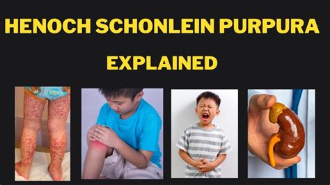Henoch Schonlein Purpura Iga Vasculitis Pathophysiology Presentations