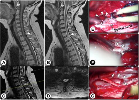 Cervical Spine Mri Herniated