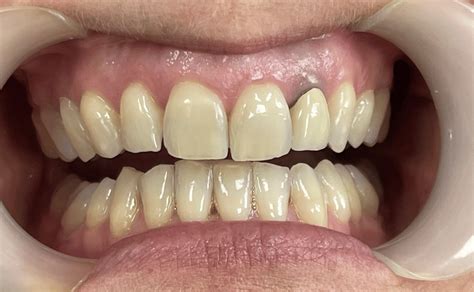 Invisalign Case 2 The Cathedral Close Dental Dentist In Cathedral Close Salisbury