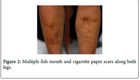 Widened Atrophic Scars