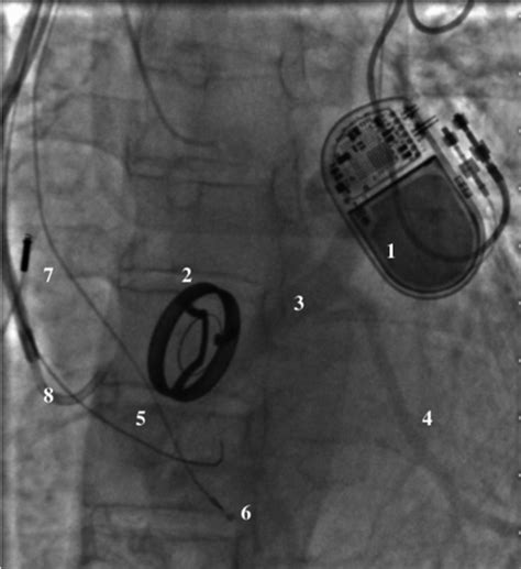 Retrograde Angiography Of The Coronary Sinus 1 Two‐cavity