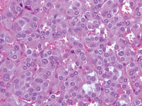 Pheochromocytoma Pathology